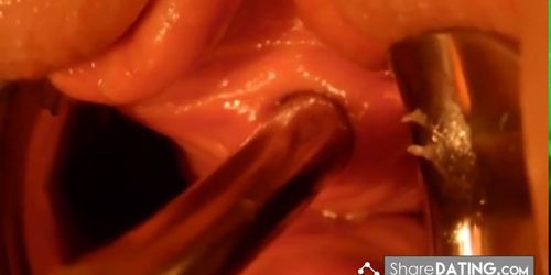 Free Catheter Porn Videos And Sex Movies Tnaflix